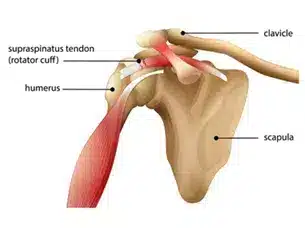 Thoracic Outlet Syndrome Expert Guide: Types & Treatment