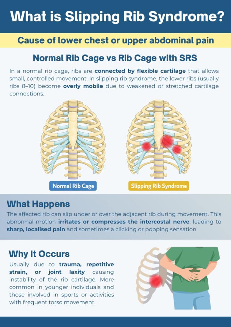 Understanding Slipping Rib: Symptoms, Causes, and Treatment Options